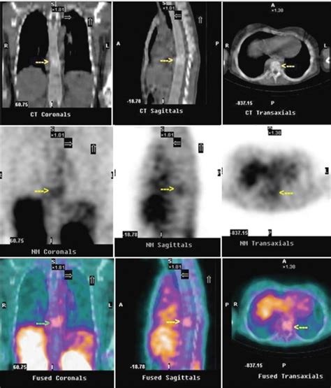 The Role Of Technetium 99m Ethambutol Scintigraphy In The Management Of
