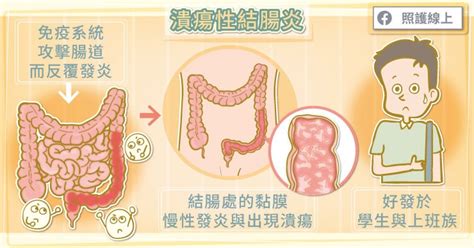 淺談發炎性腸道疾病症狀及治療方針 Pansci 泛科學