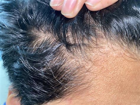 Sd Or Scalp Psoriasis R Sebderm