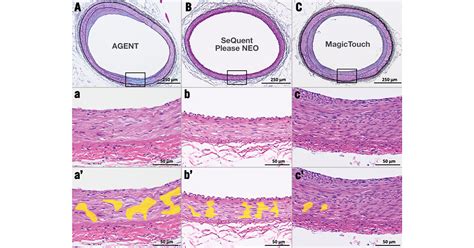 Biological Differences Of Three Paclitaxel And Sirolimus Coated