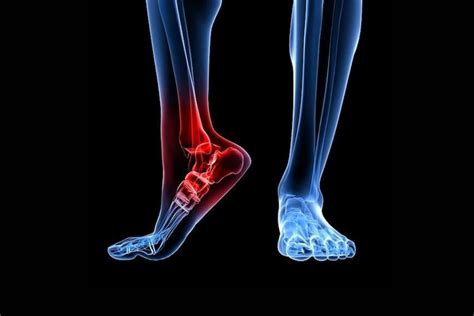40 Facts About Charcot Disease