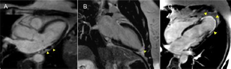 Typical Observed Patterns Of Myocardial Lge Images From Three Patients