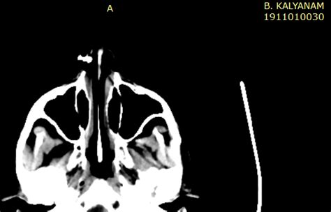 Dicom Print With Annotation · Issue 1016 · Fo Dicomfo Dicom · Github