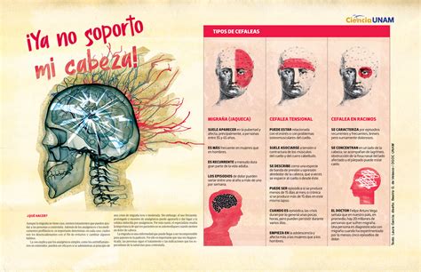INFOGRAFÍA Diferentes tipos de dolor de cabeza Ciencia UNAM