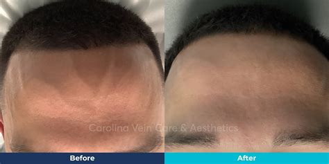 Forehead Vein Causes And Care