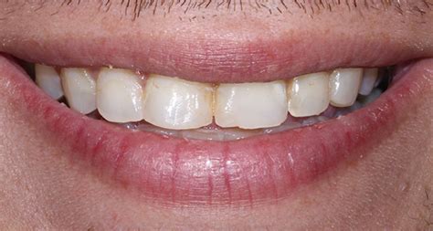 Dental Implants Manhattan New York City Ny