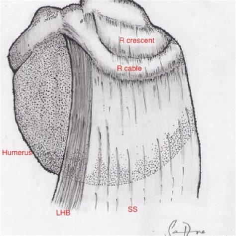 Subscapularis Tendon Short Axis A Transducer Placement Over The Download Scientific