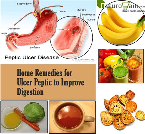 Stomach Ulcer Or Peptic Ulcer Disease Treatment Home Remedies Jethro Jeff