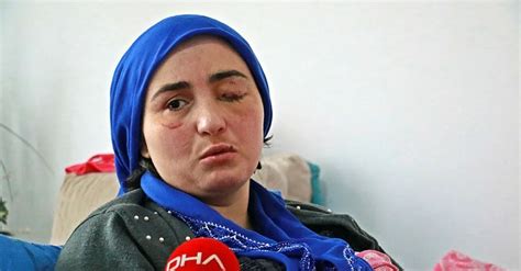 Son Dakika Haberi Eşinin şiddeti Yüzünden Gözünü Kaybetti Emine