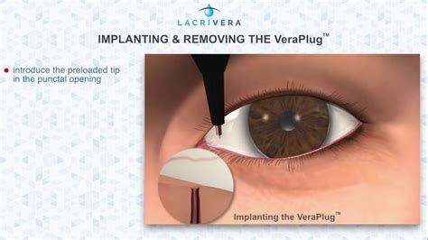 Lacrivera Veraplug Punctum Plugs For Dry Eyes Youtube