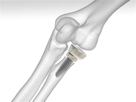Anatomic Radial Head System Acumed