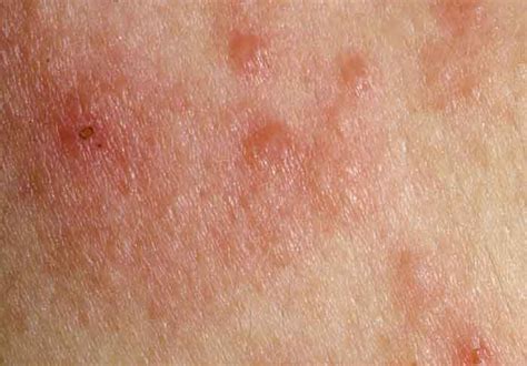 Hiv Rash On Armpit