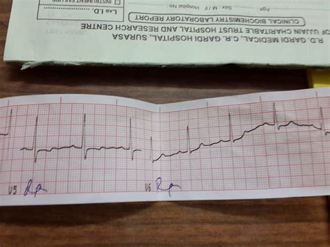 Neelz On Wheelz Dextrocardia Or Wrong Ecg