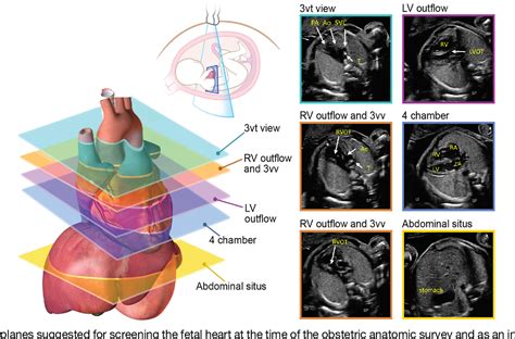 Table 2 From Guidelines And Recommendations For Performance Of The Fetal Echocardiogram An