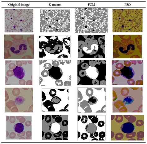 leukemia image segmentation using a hybrid histogram based soft covering rough k means