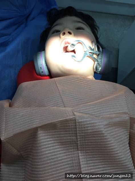 영구치 나다 첫 어금니영구치 첫 충치치료 네이버 블로그