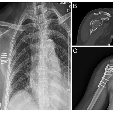 An Example Case Of A Right Proximal Humerus Fracture In A 54 Year Old