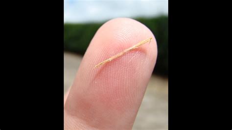 Removal Of Foreign Body Scrotum Cpt Code Simplify Medical Coding Youtube