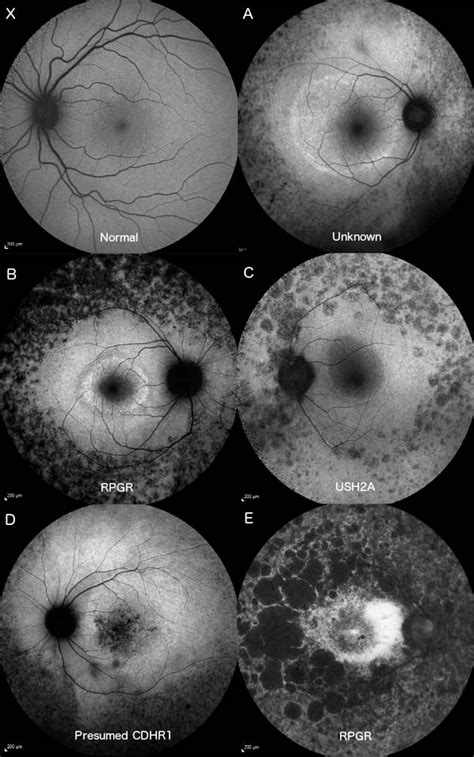 Figure 1 From A Novel Method For Quantitative Serial Autofluorescence Analysis In Retinitis