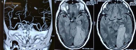Patient A 1 Left PCA P2 Segment Attenuation 2 Left PCA Infarct Download Scientific Diagram