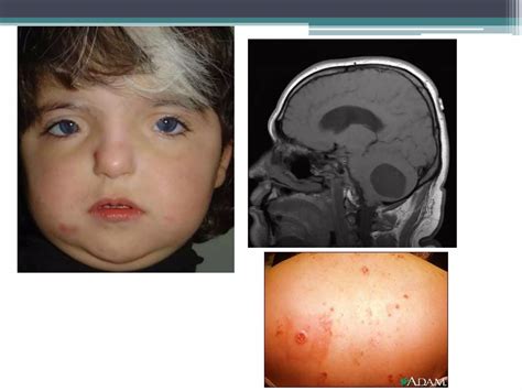 Cystic Lesions In Oral Cavity Ppt