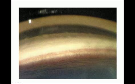 Neovascular Glaucoma International Ophthalmology Portal
