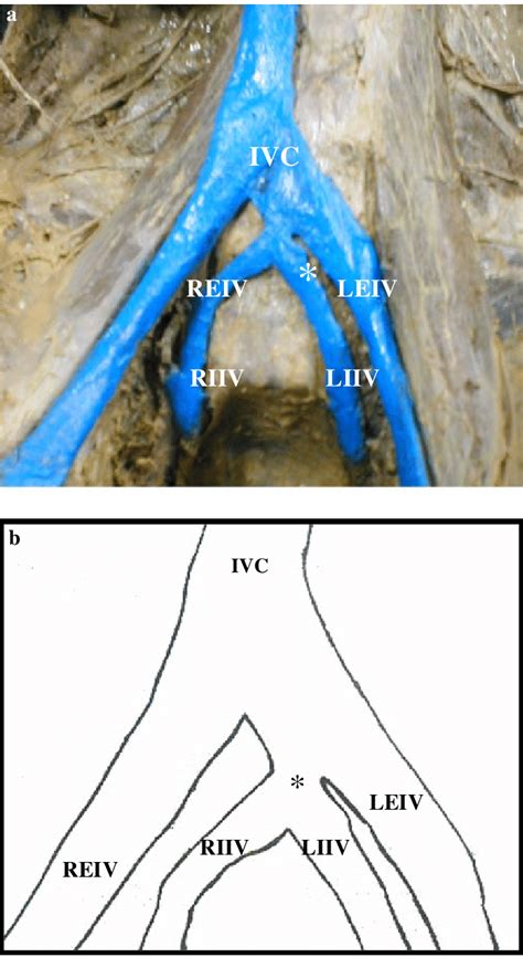 Anatomy Of The Internal Iliac Vein Around The Sacral 48 Off