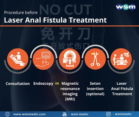 Wsm Medic What Need To Be Done Before Laser Anal Fistula