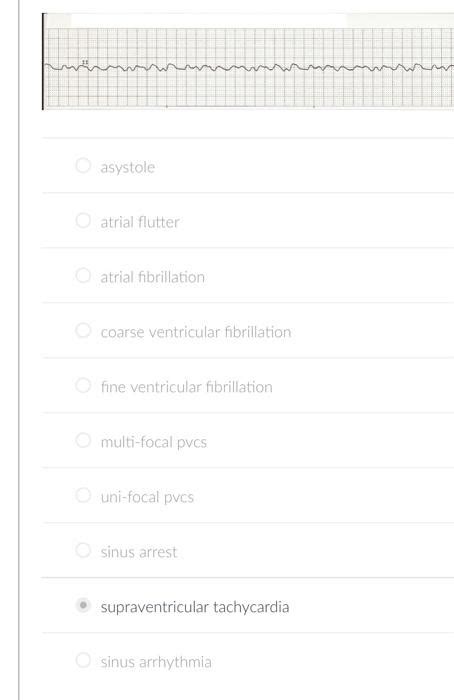 asystole atrial flutter atrial fibrillation coarse