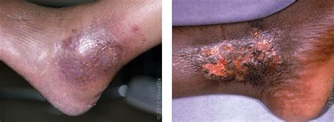 Stasis Dermatitis Pictures Causes And Treatment Goodrx