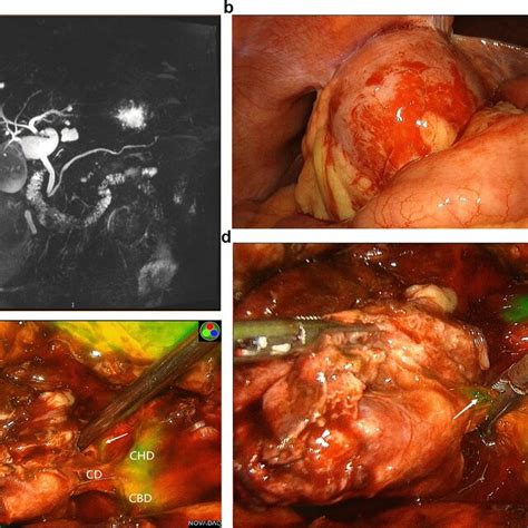 A Mrcp Showed Enlarged Gallbladder With Biliary Stasis And Obvious