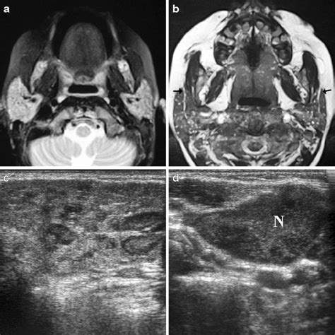 Pdf Mri And Mr Sialography Of Juvenile Recurrent Parotitis