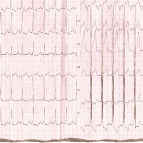 Electrocardiography Shows Left Ventricular Hypertrophy And Left Bundle Download Scientific