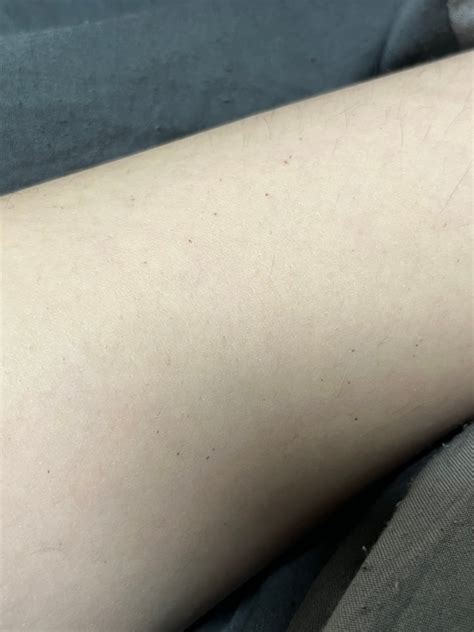 팔에 붉은 반점 지식in