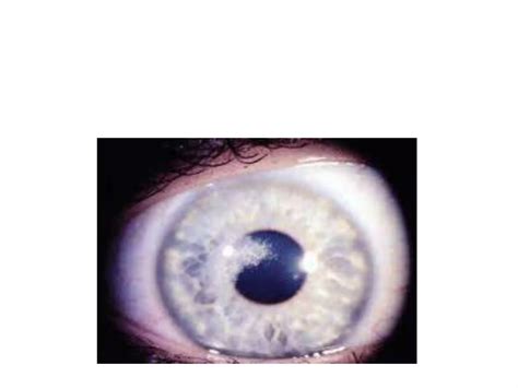 Corneal Dystrophy And Degeneration Pptx