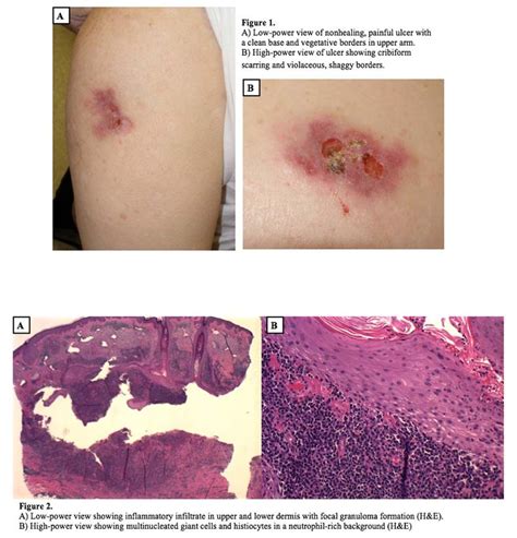 Granulomatosis And Polyangiitis Presenting As Superficial Granulomatous
