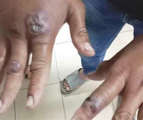 Anthrax Infections Spike In Southern Laos Champassak Province — Radio