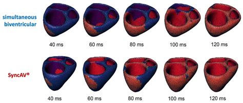 Ventricular Activation Visualized By Red Color Lateral View Left
