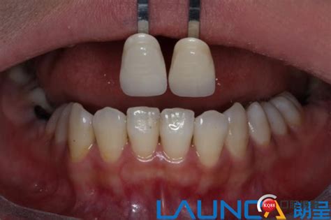 上前牙外伤数字化美学修复 牙科小李子的博客 Kq88口腔博客 上前牙外伤数字化美学修复 牙科小李子的博客 Kq88口腔博客