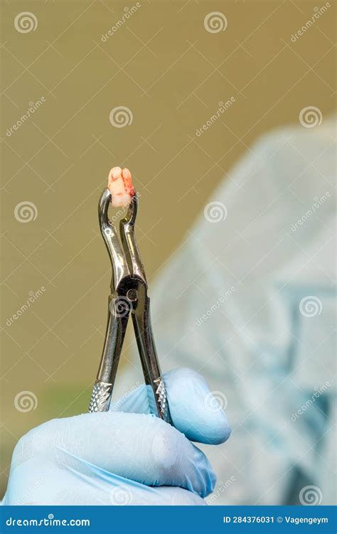 Wisdom Tooth Removal Extraction Third Molar Stock Image Image Of