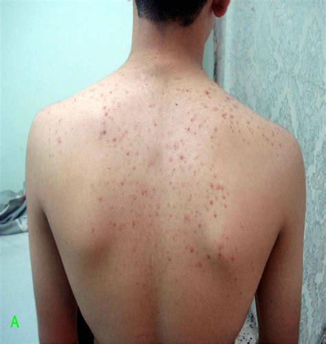 Fungal Folliculitis Neck