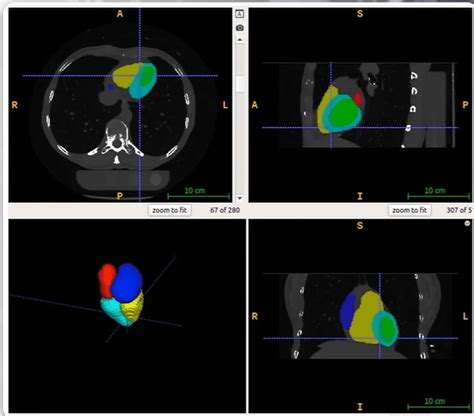 Fda Clears Ct Based Ai Software For Detecting Enlarged Heart Chambers
