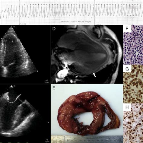 A Telemetry Tracing Showing Monomorphic Ventricular Tachycardia B
