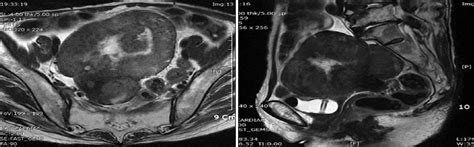 T1 Weighted Magnetic Resonance Axial And Sagittal Imaging Shows 9 ×