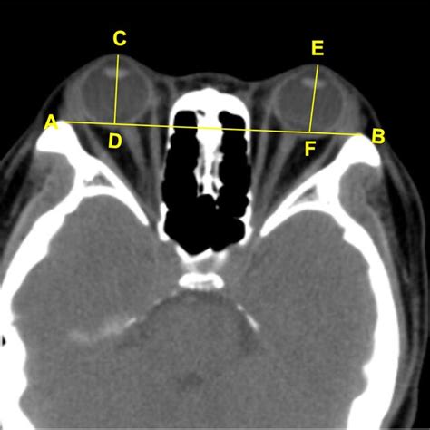 The Measure Exophthalmos Based On Ct Imaging Ab Is The Orbital Outer