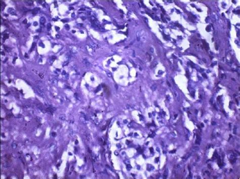 Figure 1 From T2 Breast Cancer Presenting With Diffuse Liver Metastases