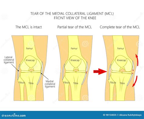 Ligaments Of The Kneetear Of The Medial Collateral Ligament Stock Vector Illustration Of Bone