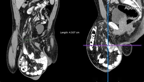 Surgical Treatment For Inguinoscrotal Hernia With Loss Of Do