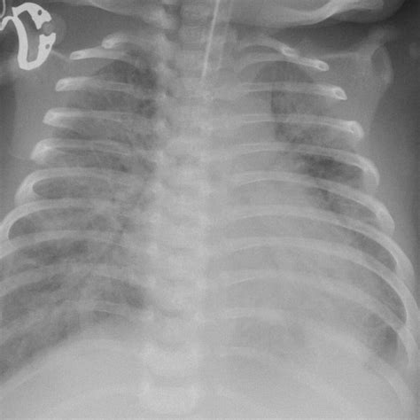 Pneumonia Combine Kaggle