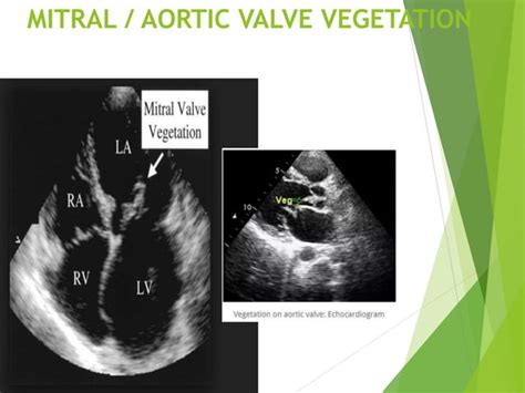 Infective Endocarditis Echo Dr Khaled Ppt Heart And Cardiovascular